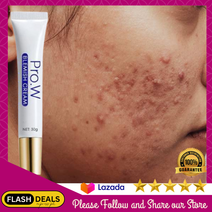 " PANTANGGAL PEKAS SA MUKHA, TIGYAWAT, WHITEHEADS, BLACKHEADS DARK ...