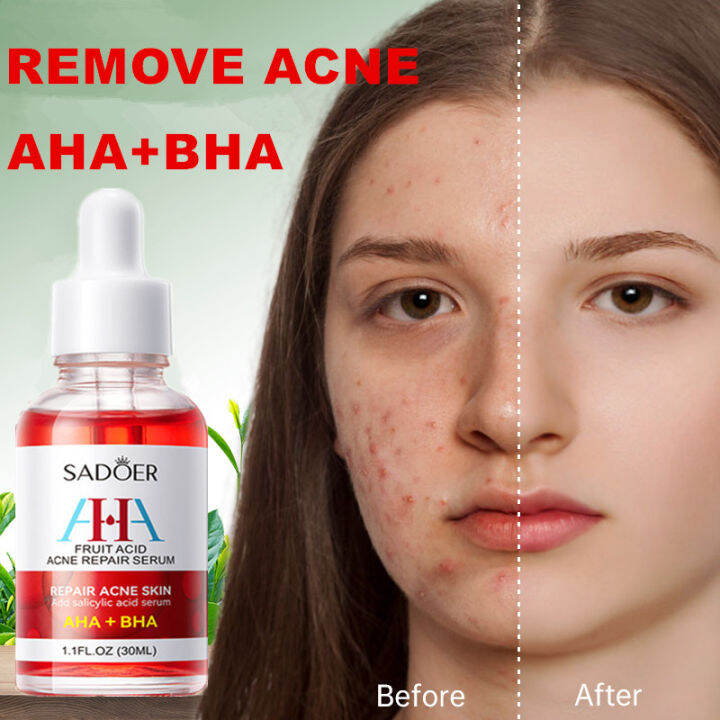 SADOER Face Serum Fruit Acid Repair Acne Treatment Salicylic Acid Pore Shrinking 30ml | Lazada ...