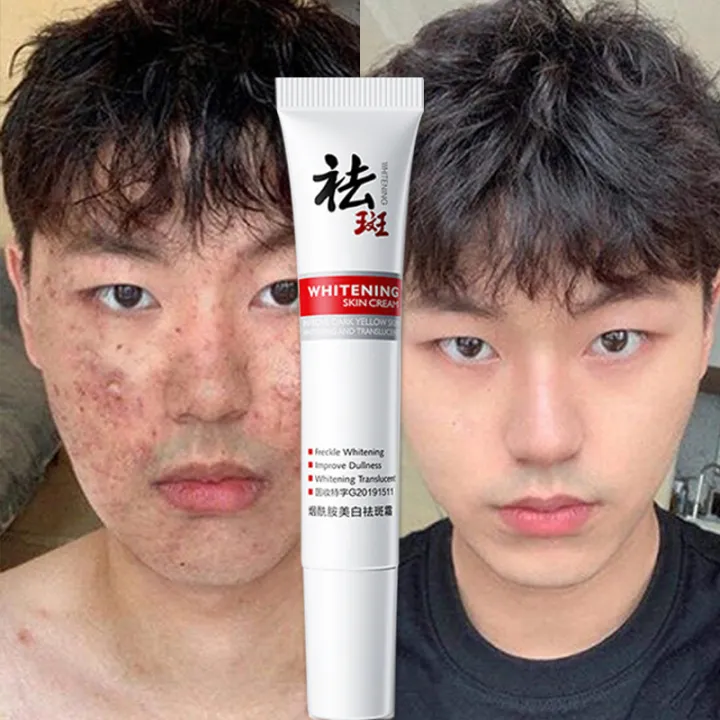 Whitening Freckle Cream Removal Melasma Anti Aging Serum Remover Cream ...