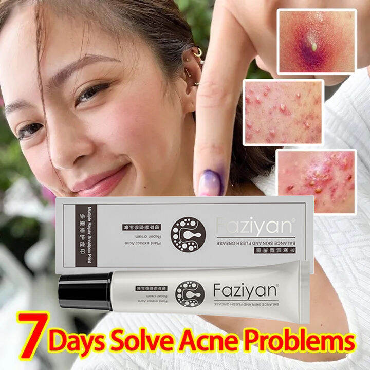 100% Effective Quickly Pimple Remover Cream Acne Repair Cream fade acne scar repair skin Acne ...