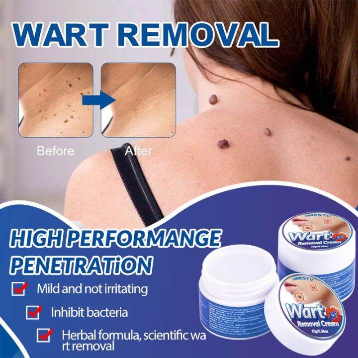 Fast Wart Removal Cream Original Ointment Against Condyloma acuminata ...