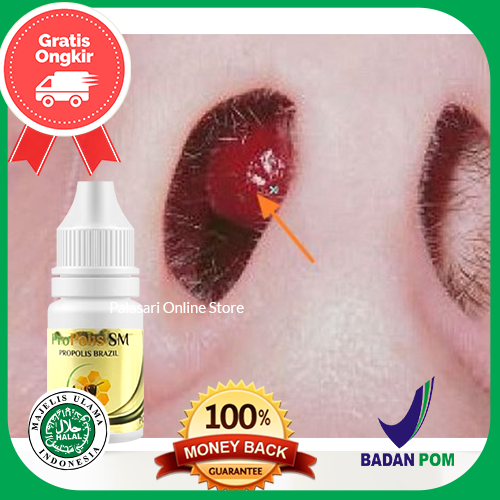 obat benjolan di hidung, polip, benjolan polip, polip di hidung ...