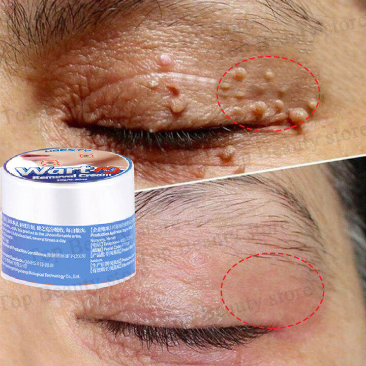 Warts Remover Original Cream Warts Magic Remover Wart Ointment Original ...