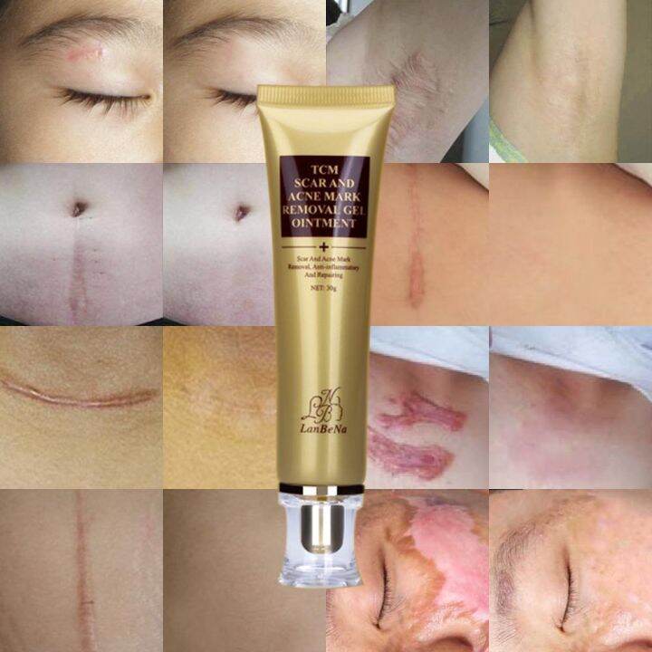 TCM Scar Removal Cream Acne Treatment Acne Control Acne Scar Removal ...