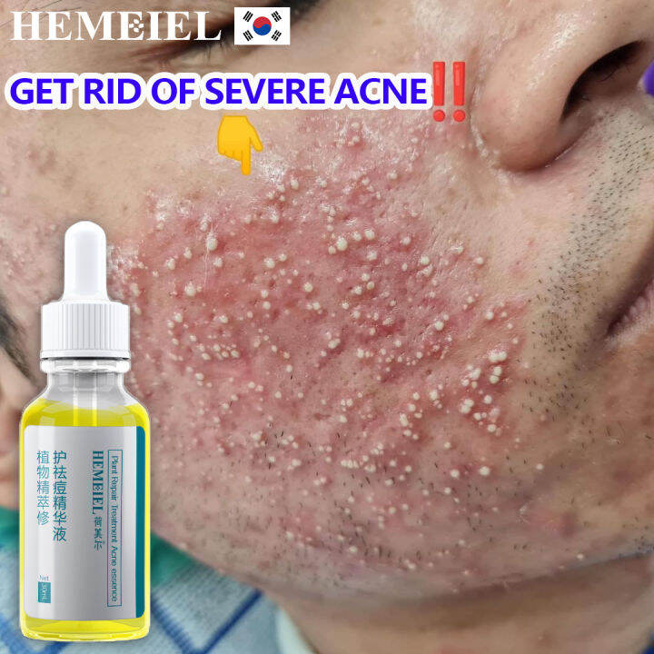 HEMEIEL Oxecure Acne/Pimple Eraser Quick Fx/Anti Acne And Pimples ...
