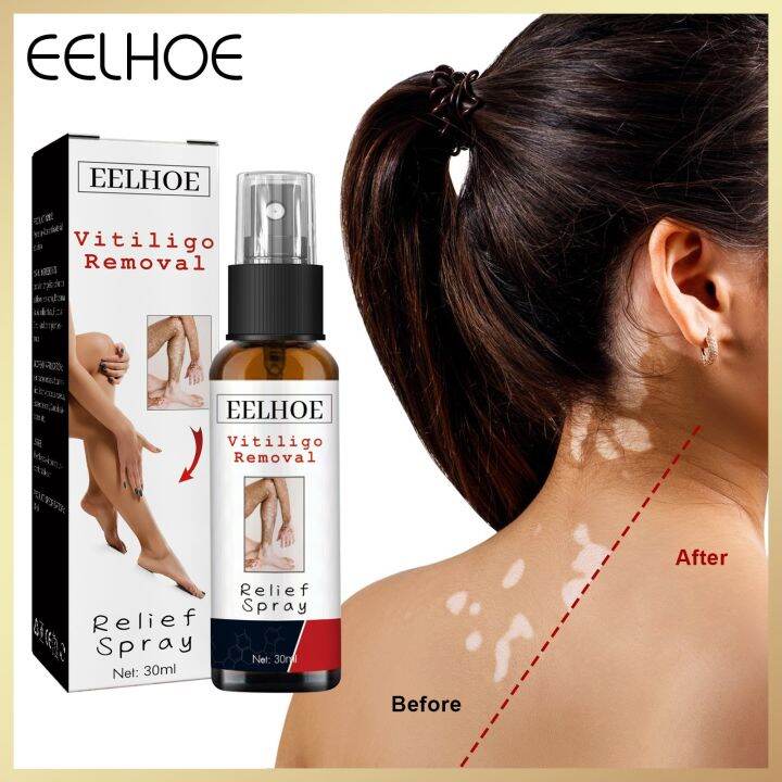 Eelhoe Vitiligo Removal Relief Spray Leukoplakia Disease Moisturize ...