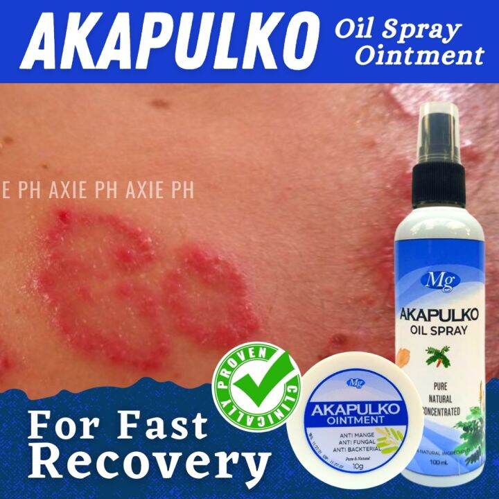 [AXIE PH] Magnesium Akapulko Oil Spray and Ointment Treat Fungal ...