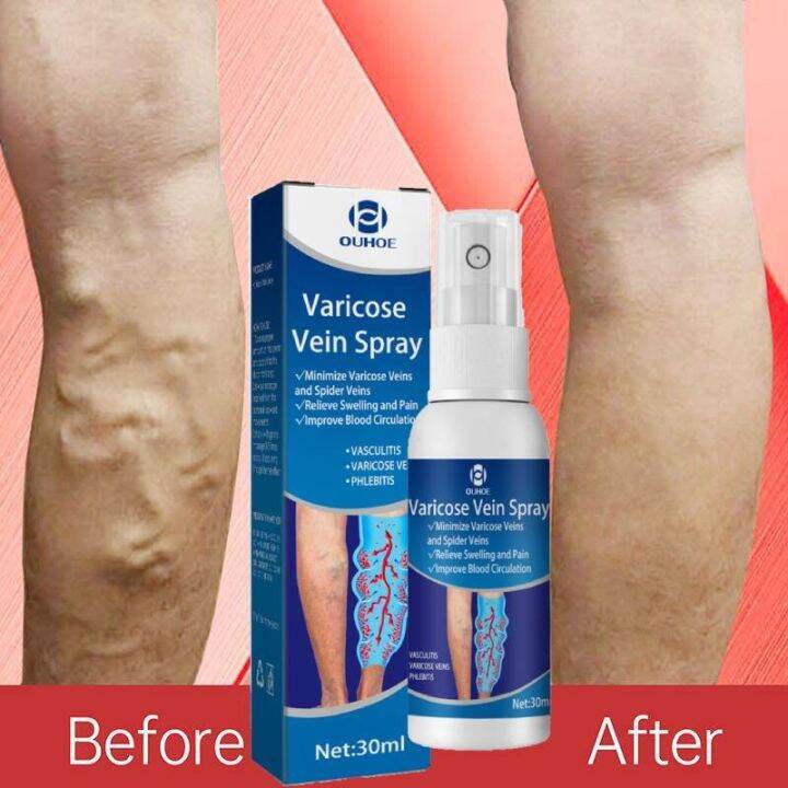 LADES【OUHOE】Varicose Veins Spayer Treatment Essential Oil Relief ...