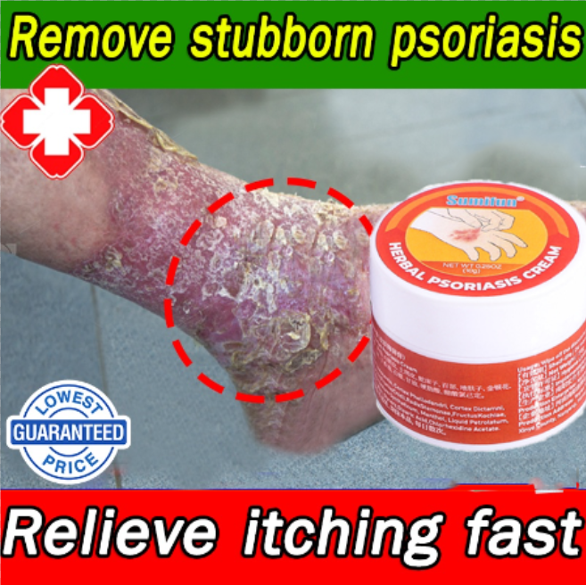 Solve all skin problems👍Sumifun Psoriasis Eczema Cream for Skin Disease ...