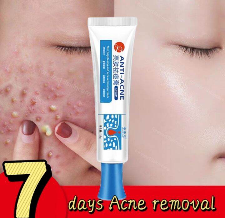 100% Effective Remove Pimples cream ng acne Quickly Pimple Remover Acne Cream Fades Acne Marks ...