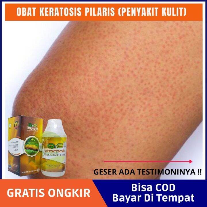 Obat Salep Keratosis Pilaris - Penyakit Kulit Ayam - Brutusan Di Kulit ...
