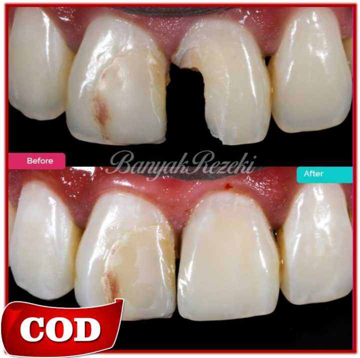 Penambal gigi ompong patah Tambal gigi bolong permanen original Tambal gigi bolong depan ...