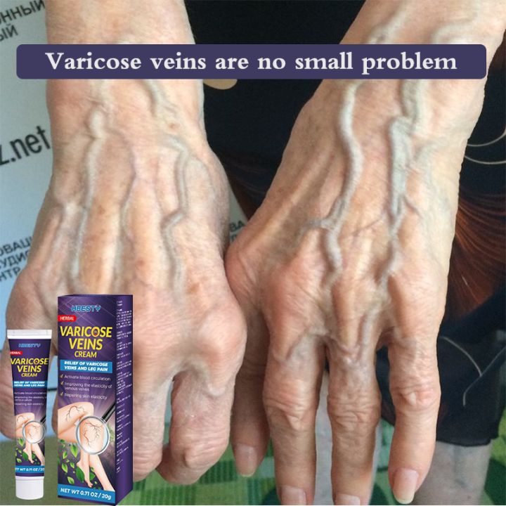 varicose veins cream、varicose veins treatment cream20g、Effective ...