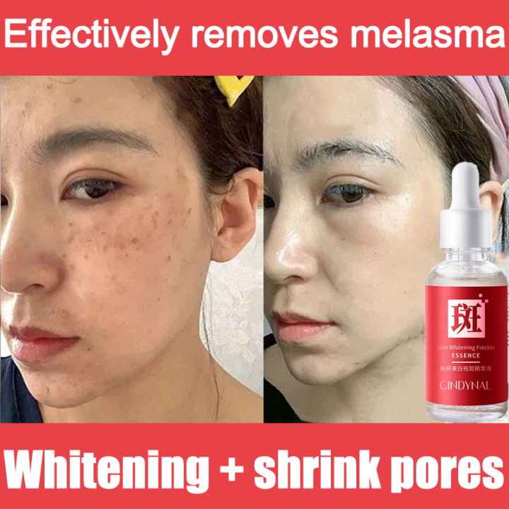 【Fast delivery】CINDYNAL whitening serum melasma remover dark spot ...