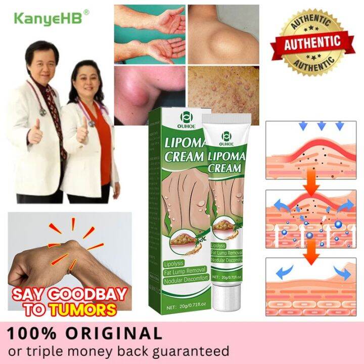 KanyeHB Lipoma Removal Cream original Japan lipoma ointment Skin ...