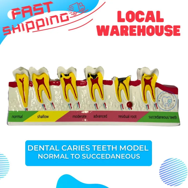 Dental Caries Teeth Model of Pathological Process Around Teeth Caries ...