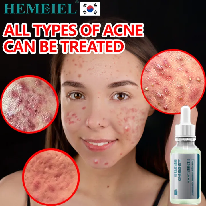 HEMEIEL Pimples & Acne Remover Best Seller/Pimple Remover/benzoyl ... HEMEIEL Pimples & Acne Remover Best Seller/Pimple Remover/benzoyl ...