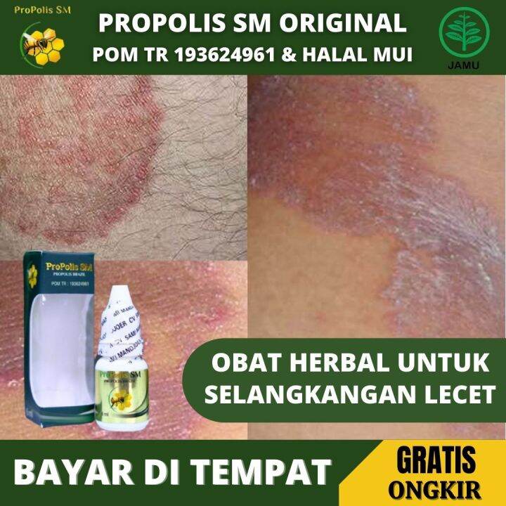 Obat Luka Babak Pada Selangkangan - Obat Salep Oles Selangkangan Gatal ...
