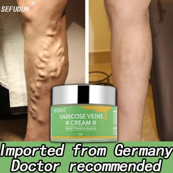 True and effective Varicose Veins Treatment Cream Relieve pain and ...