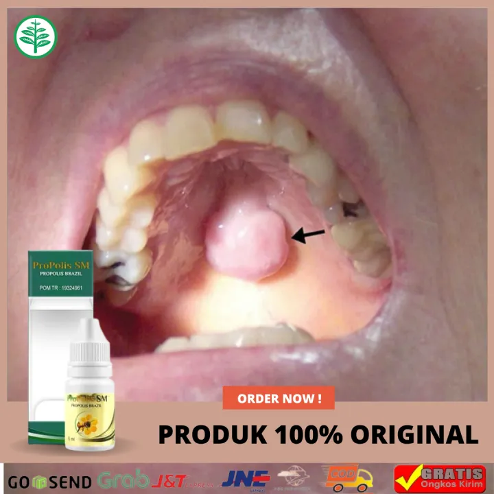 Obat Benjolan di Langit Mulut, Penghilang Benjolan Dilangit Mulut, Obat ...
