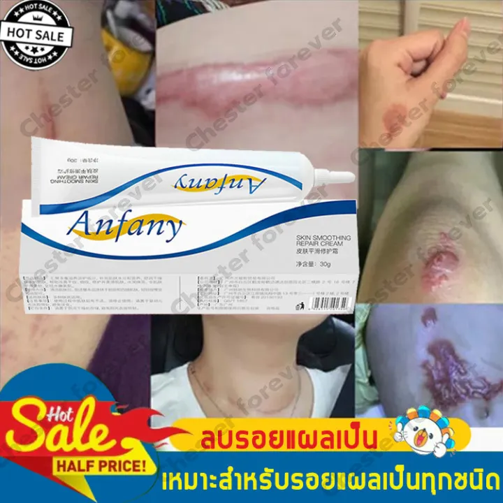 ANFANY ครีมลดรอยแผลเป็น ครีมทาแผลเป็น ครีมลดรอยสิว เจลลบรอยแผลเป็น ครีมลดแผลเป็น ครีมลบรอย ...