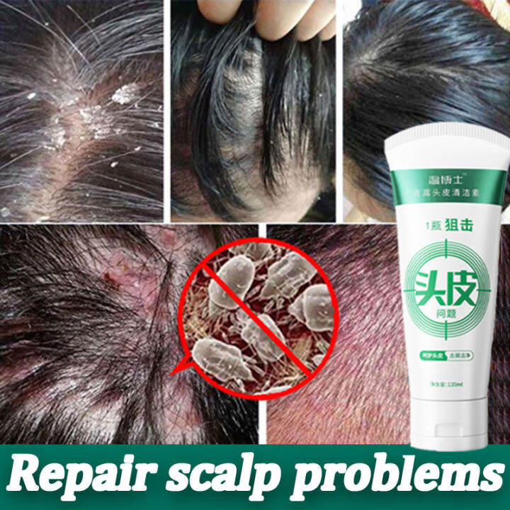 Anti Dandruff Scalp Treatment Hair Mites Shampoo Hair Loss Soothing