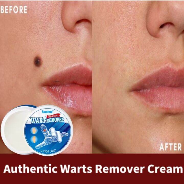 Authentic Kasoy Cream Warts Remover Very Effective And Safe Treatment ...