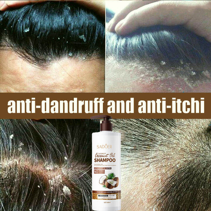 Coconut oil amino acid shampoo Nourishing Anti Dandruff Itchy Scalp Oil ...