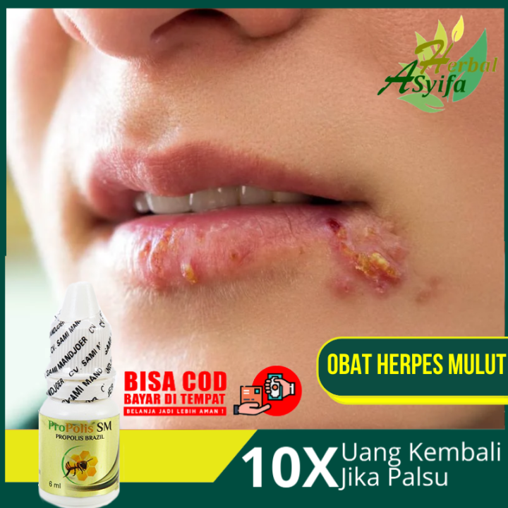 Obat Herpes Mulut - Obat Penyakit Herpes di Mulut - Obat Herbal Herpes ...
