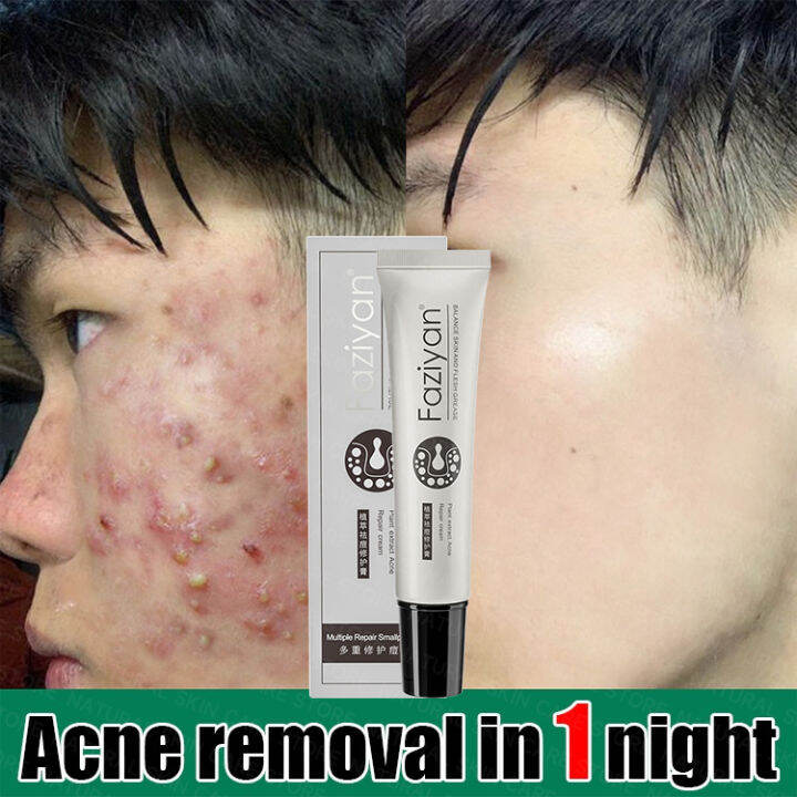 Pimple Remover Acne Cream Quickly Remove Pimples Fades Acne Marks Repairs Acne Pits Facial Scar ...