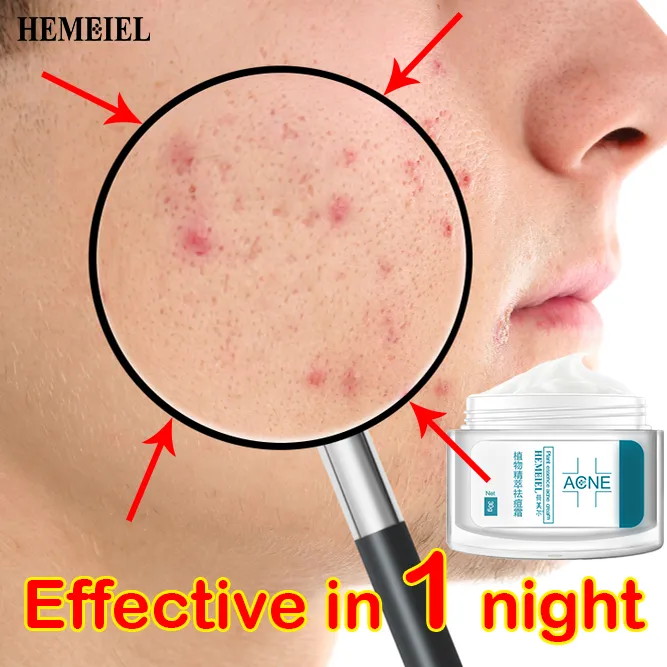 HEMEIEL Acne Treatment Cream / Pimple Marks Remover / Pang Tanggal Ng ... HEMEIEL Acne Treatment Cream / Pimple Marks Remover / Pang Tanggal Ng ...