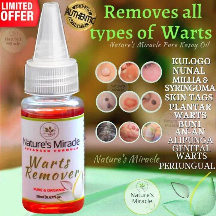 Warts Remover Skin Tags Remover, Mole Remover, Nunal Remover, Kulugo ...