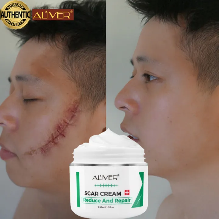 ALIVER Scar Remover Cream50mlNew and old scars on the body Remove ... ALIVER Scar Remover Cream50mlNew and old scars on the body Remove ...