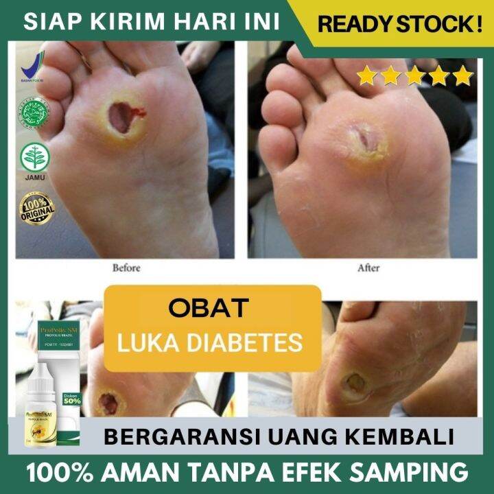 PROPOLIS SM Untuk Luka Diabetes - Obat Tetes Penyakit Gula, Penghilang ...