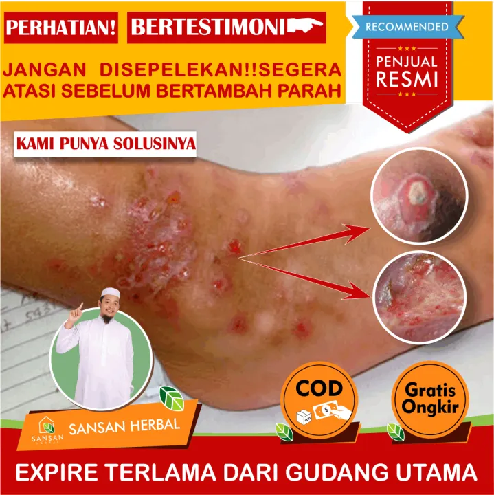 Obat Gatal2 Bernanah, Obat Gatal dan Bernanah, Obat Kulit Gatal Bernanah, Salep Untuk Gatal ...