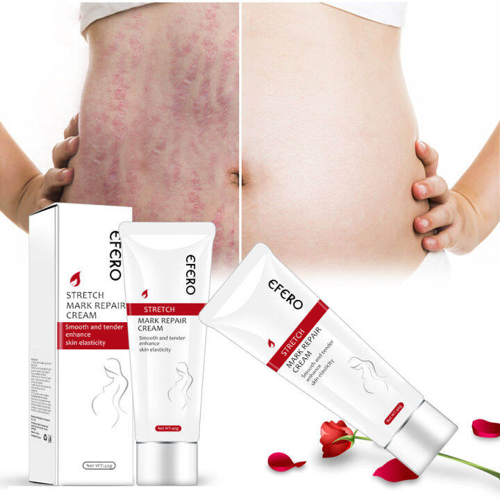 Elimination Of Stretch Marks Repair Cream Postpartum Elimination Of ...