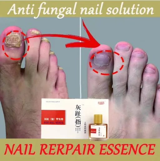 Gray Nail, Onychomycosis Repair Medical, Paronychia Cleaning Kit【25 ml ...