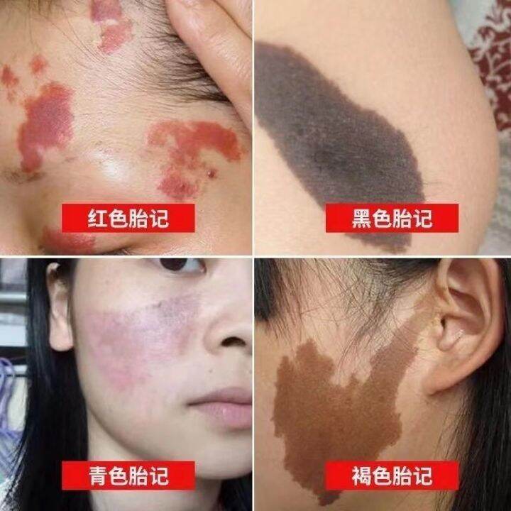 [Quick Birthmark Removal] Birthmark Removal Artifact Removing Melanin ...