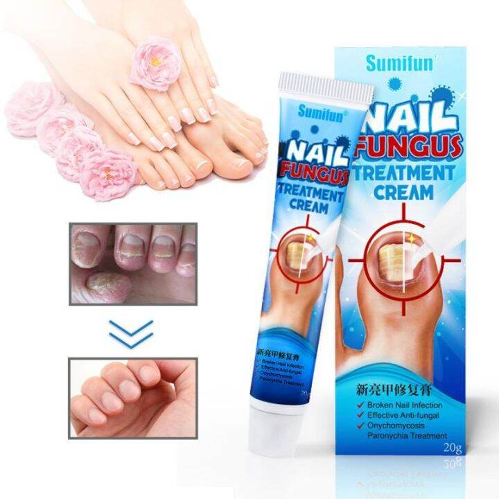 Antibacterial Cream Anti Fungal Cream Nail Fungus Treatment Paronychia