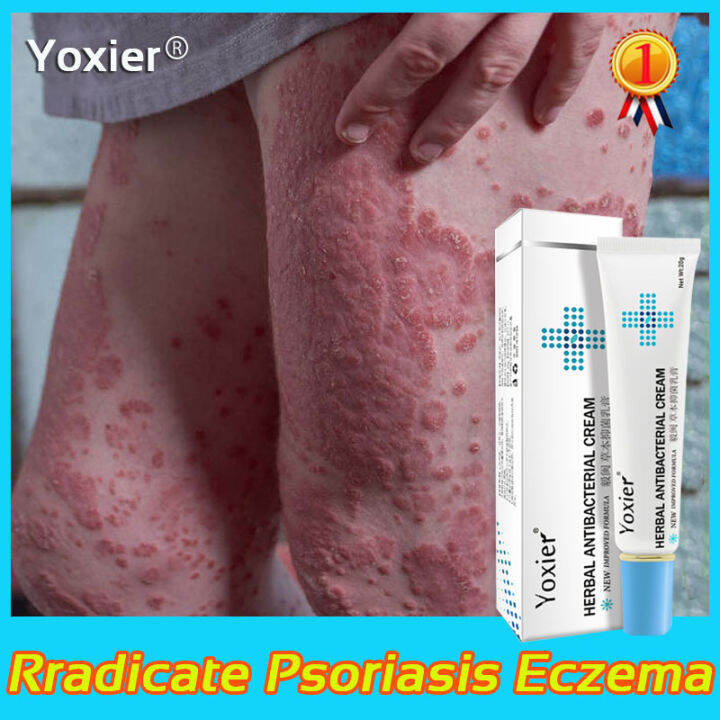 Solution Psoriasis Eczema Yoxier Eczema Ointment 20g Professional ...