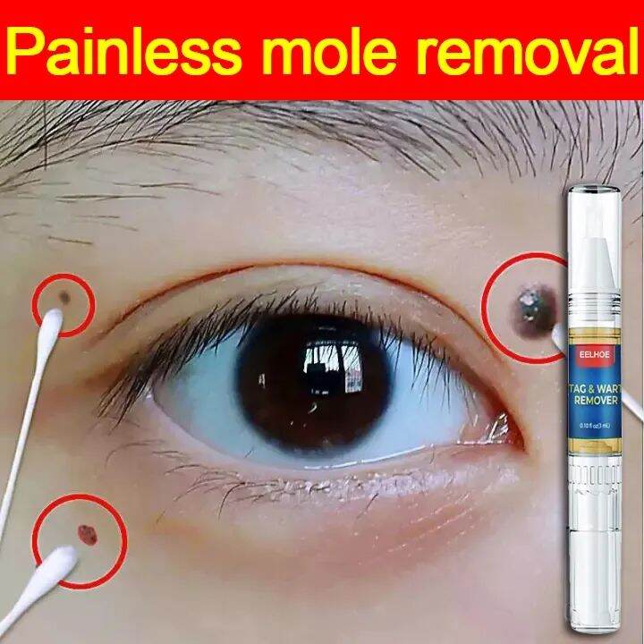 【EELHOE】Wart Remover Pen Skin Krim Penghilang Kutil Mole Removal Pen ...