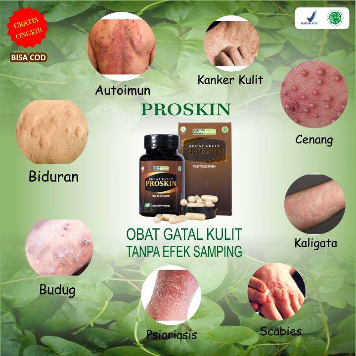 Obat Gatal Gatal Pada Kulit, Gatal Kulit Alergi, Gatal Kulit Anak, Obat ...