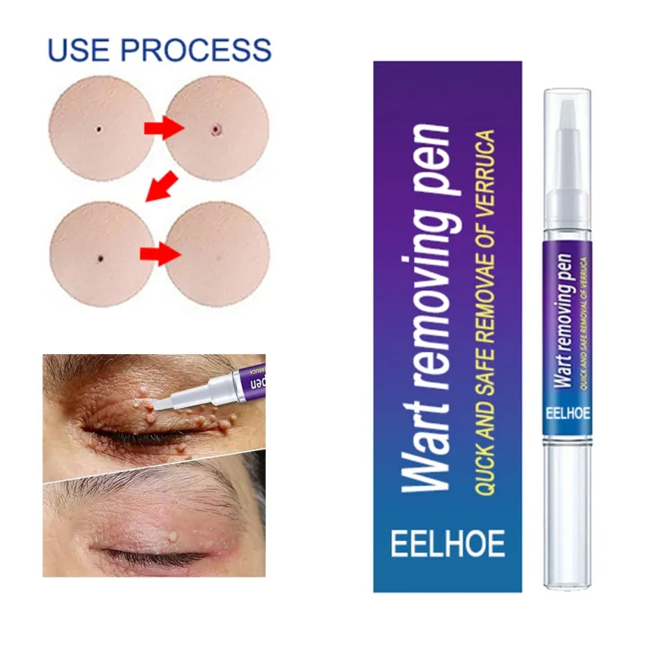 Wart Remover Tag Papillomas Moles Removal Painless Face Freckle Plaster ...
