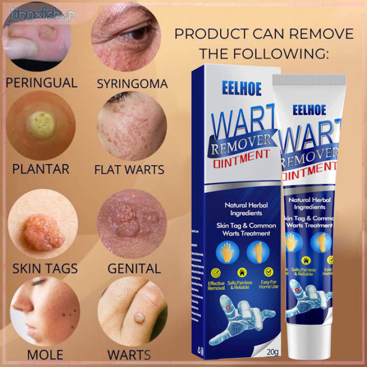 Warts Remover Original Cream 20g Warts Magic Remover Wartz Removal ...