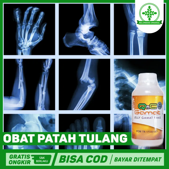 Obat Patah Tulang - Tulang Tulang Remuk - Tulang Keropos - Tulang Retak ...