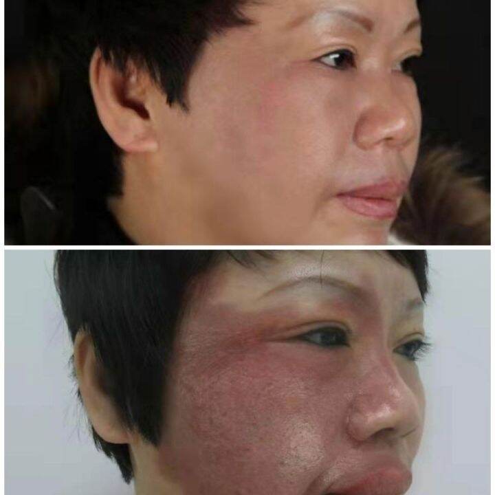 [Quick Birthmark Removal] Birthmark Removal Artifact Removing Melanin ...