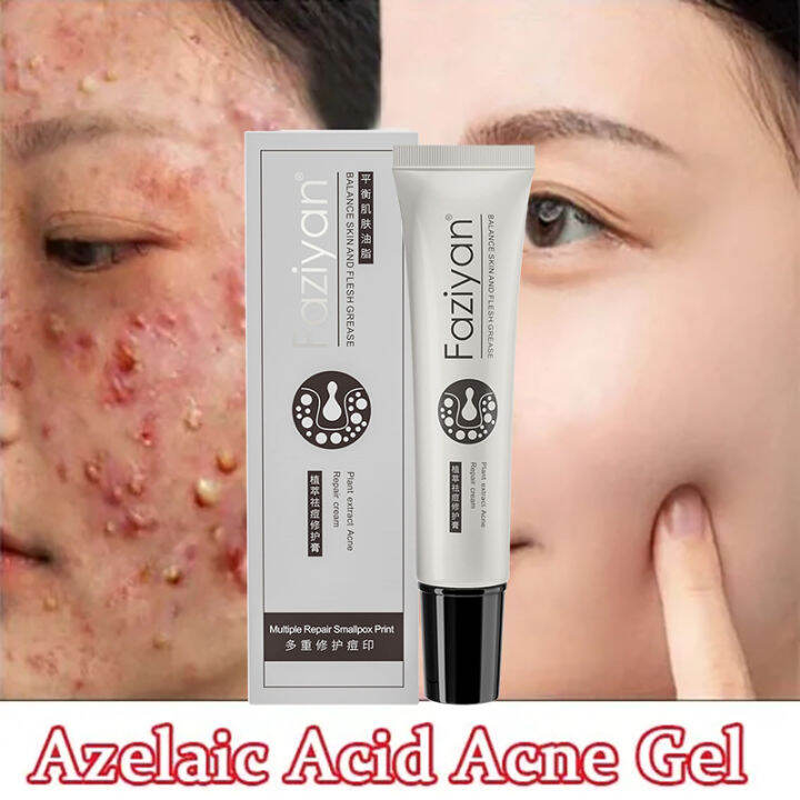 Effective Anti Acne Cream Acne Eraser Pimple Remover Acne Scar Repair ...