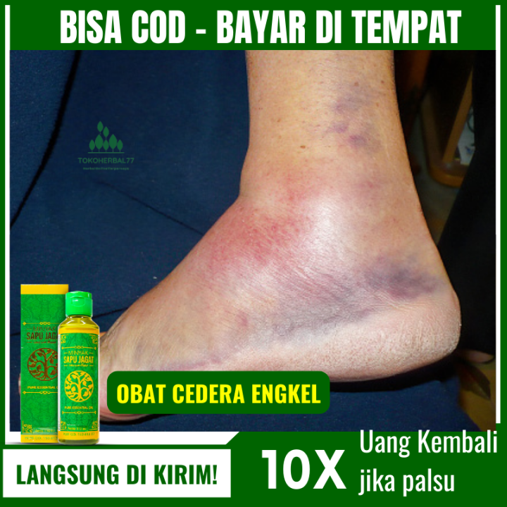 Obat Cedera Engkel, Nyeri Pergelangan Kaki, Ankle Sprain, Keseleo, Kaki ...