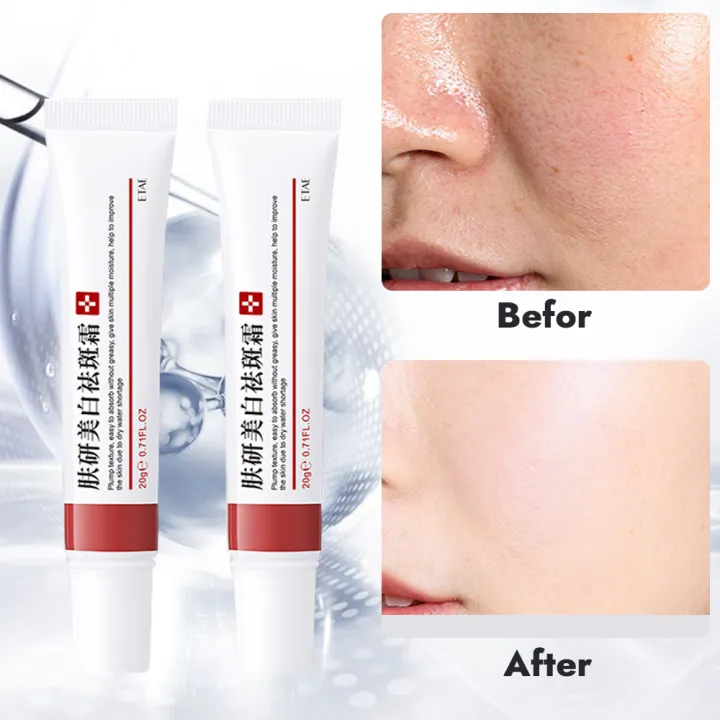 Freckle Removal Whitening Cream Melasma Removal Cream Anti-chloasma ...