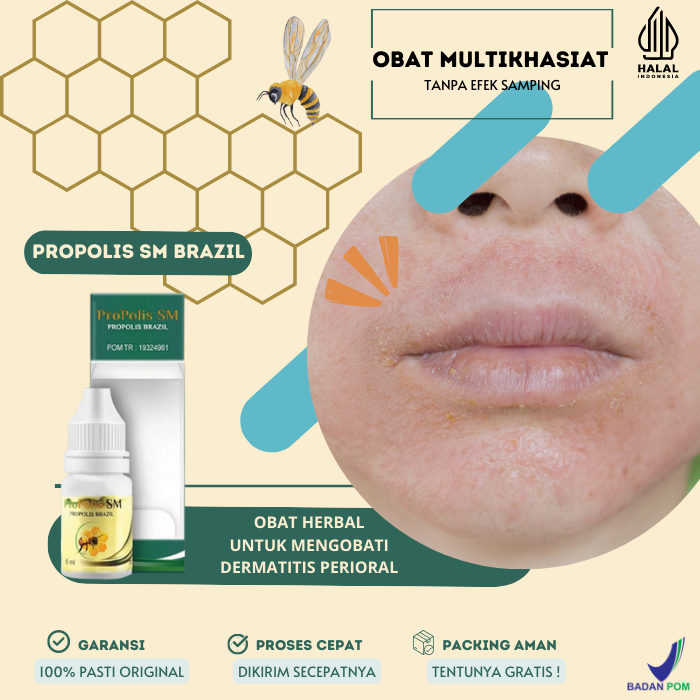 Obat Dermatitis Perioral, Benjolan Kecil Merah Di Sekitar Mulut, Dagu ...